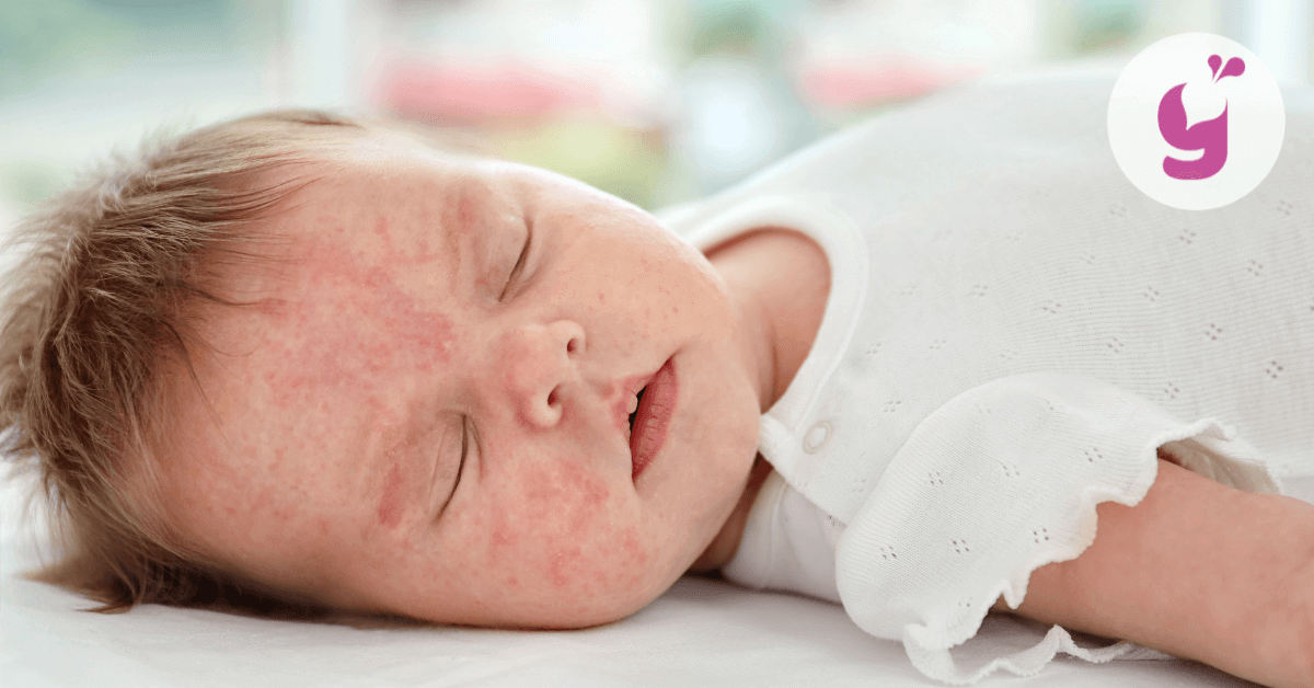 Čo pomáha na atopický ekzém u detí a bábätiek? 10 tipov